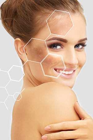 Pigmentation Treatment | Needleless South Africa